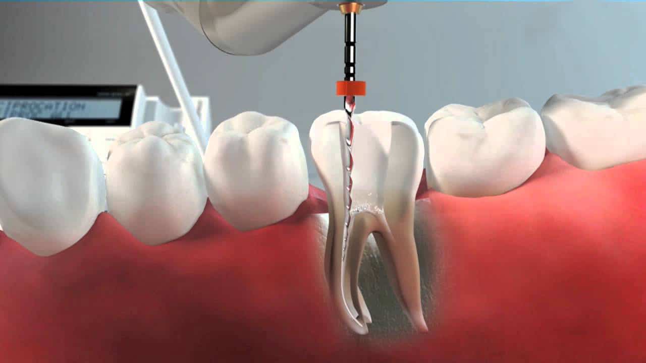 endodoncista: Todo lo que debes saber sobre la carrera