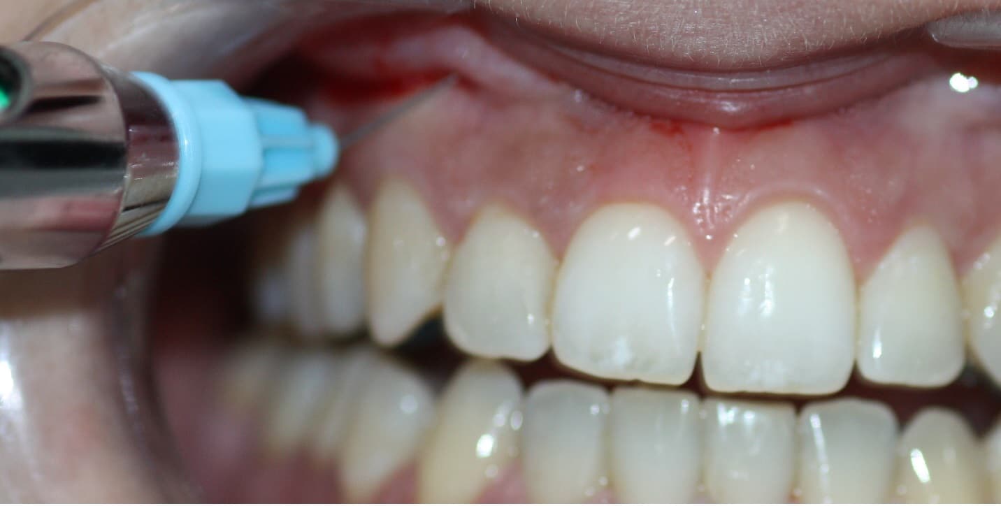 periodoncista: Qué es, que hace y mucho más sobre la carrera